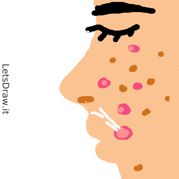How to draw acne / 8irp1fkcc.png / LetsDrawIt